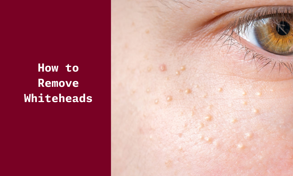 How to Remove Whiteheads: A Comprehensive Guide | Ningen - Ningen